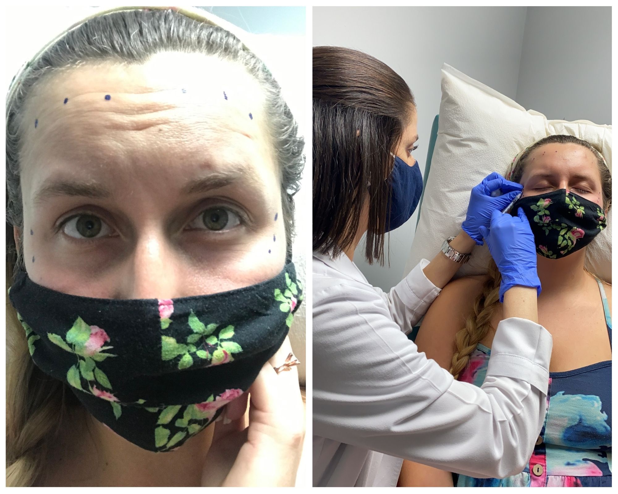 I Tried 'Boxed Botox' & The Real Thing — Here's My Honest Review ...