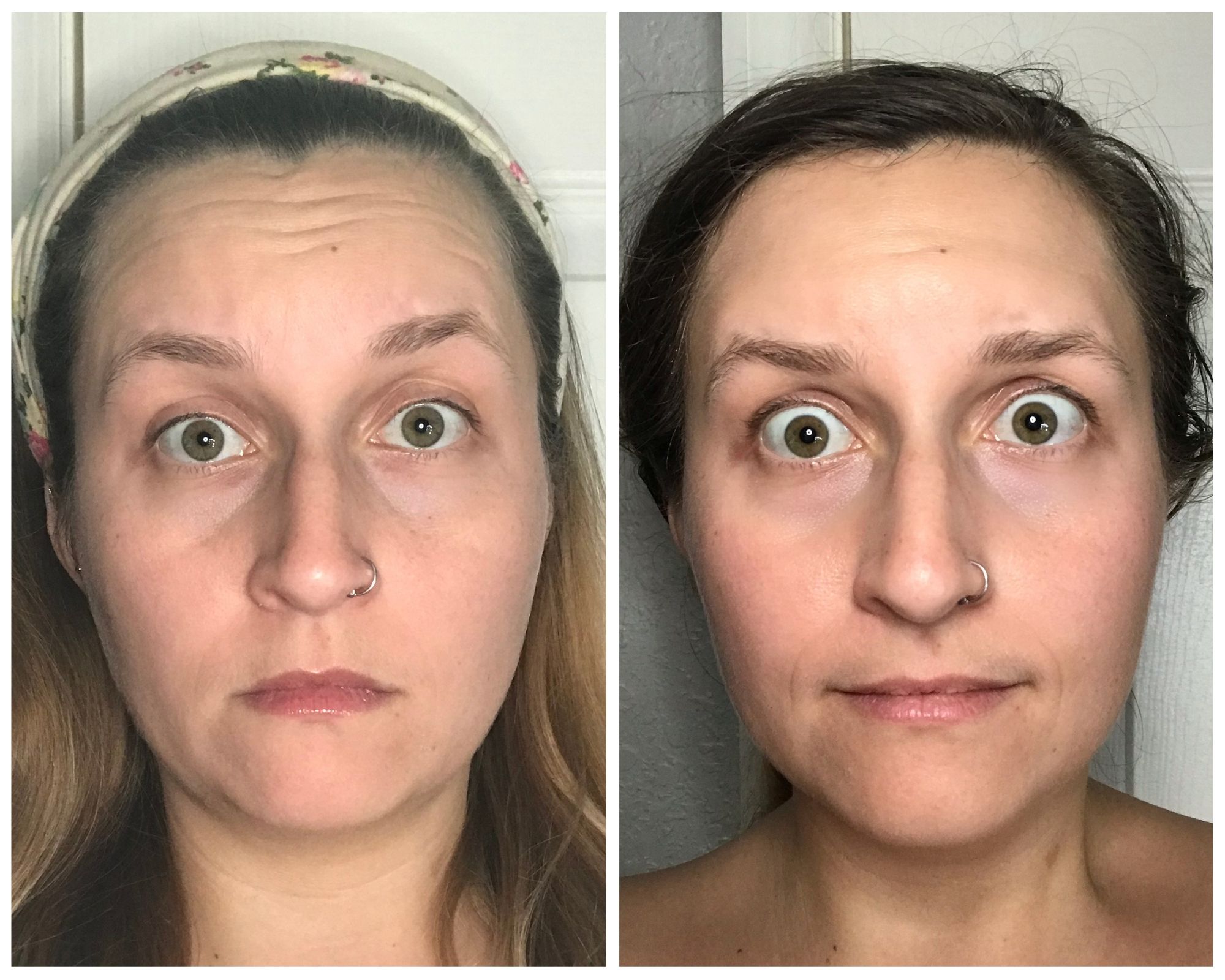I Tried 'Boxed Botox' & The Real Thing — Here's My Honest Review ...